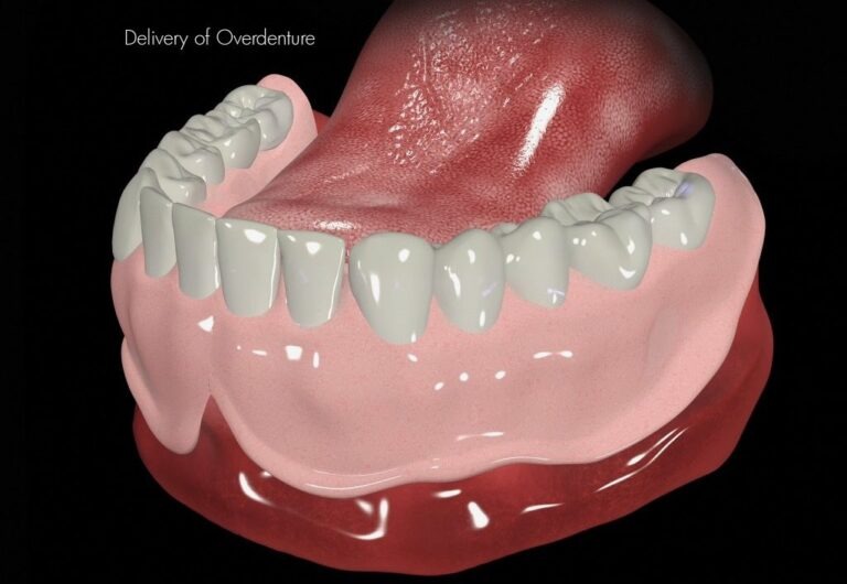Lower implant locator denture 8 - Woods Dental