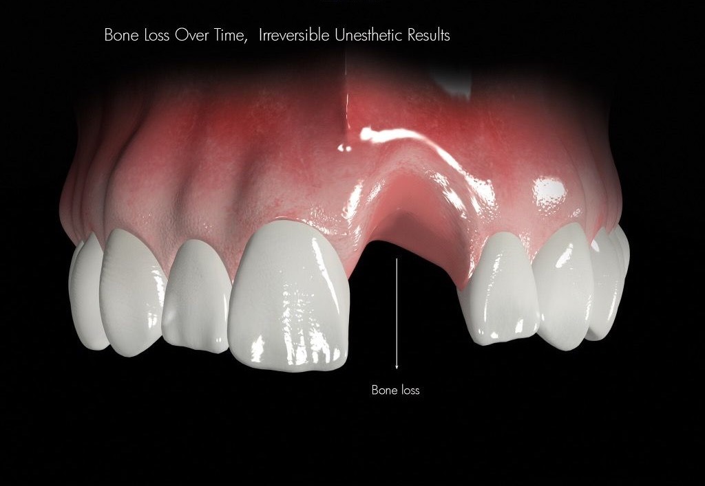 Replace a Single Tooth Swansea | Dental Implants Swansea