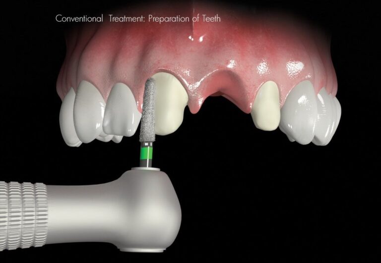 Replace a Single Tooth Swansea | Dental Implants Swansea